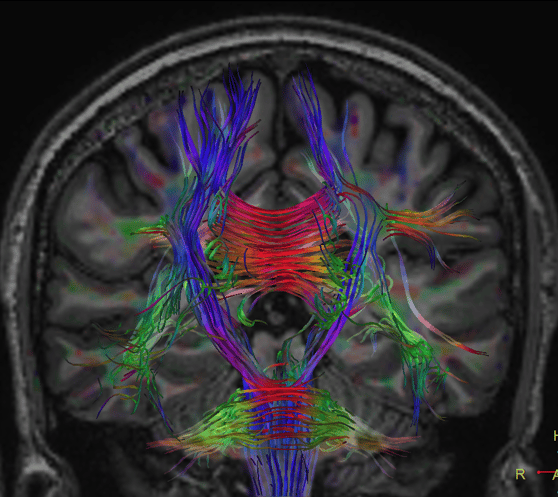 ¿Qué es la conectividad cerebral?